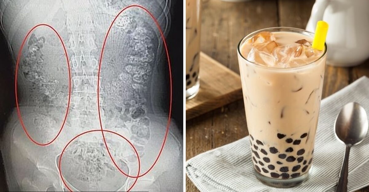 Amante del “bubble tea” vivió una pesadilla: ¡más de 100 bolas de ...